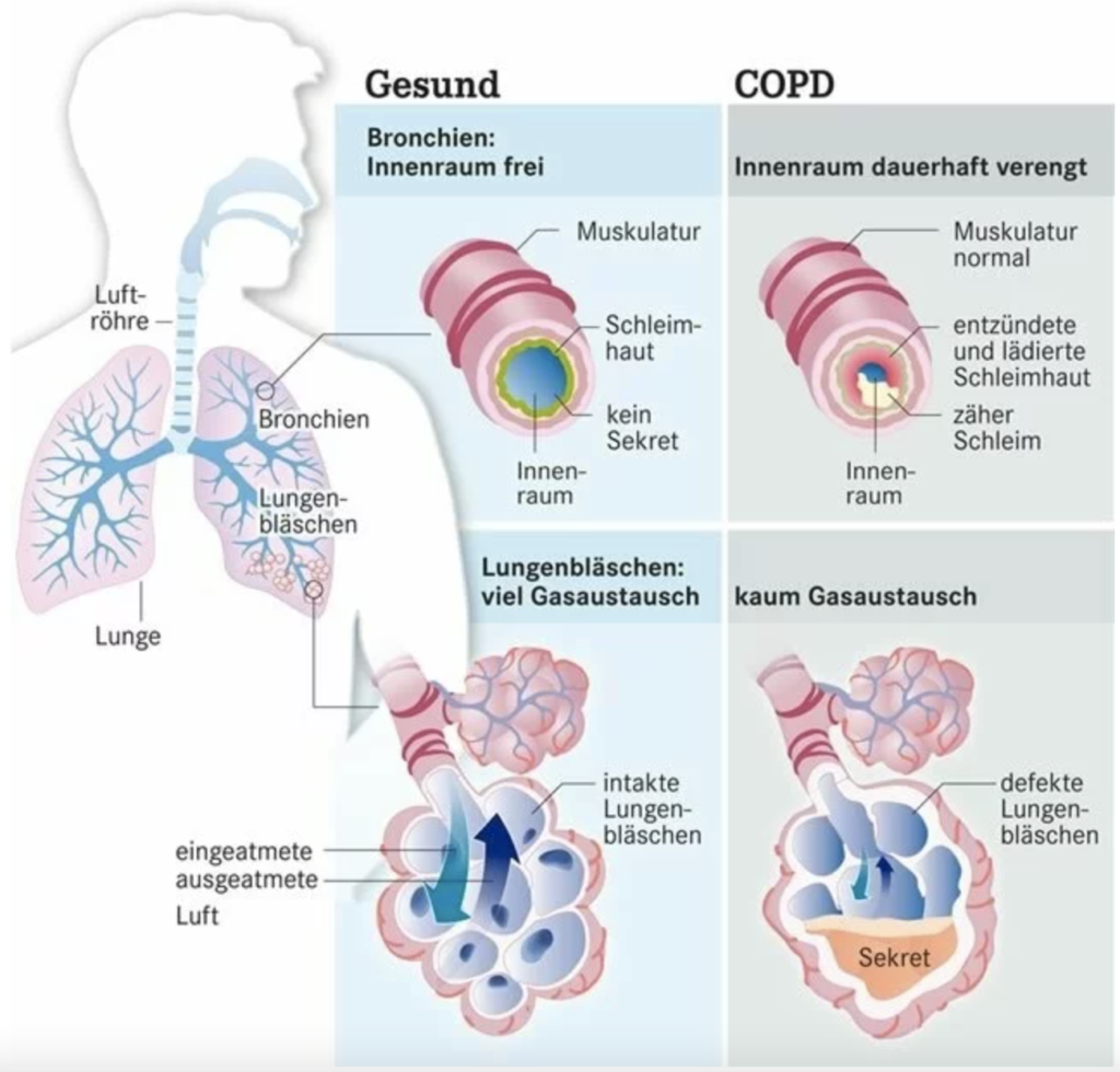 COPD - Myokraft - Physio | Ergo | Fitness | Health